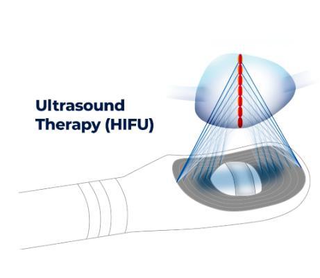 EDAP Announces First Pancreatic Cancer Patient Treated with Proprietary ...