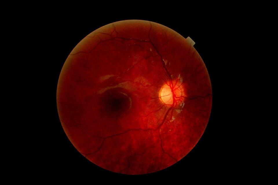 Retinal implant returns sight to patients with severe vision loss ...