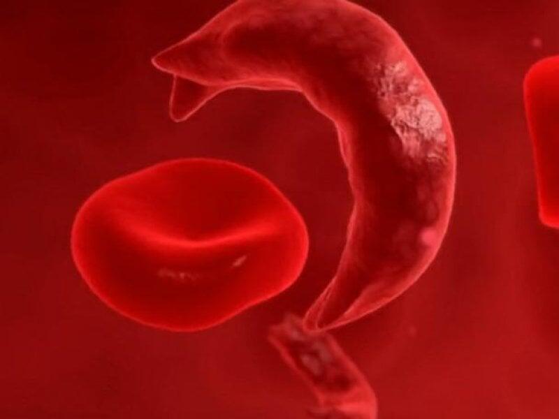 Casgevy costs $2.2 million: First patient outside of a trial receives ...