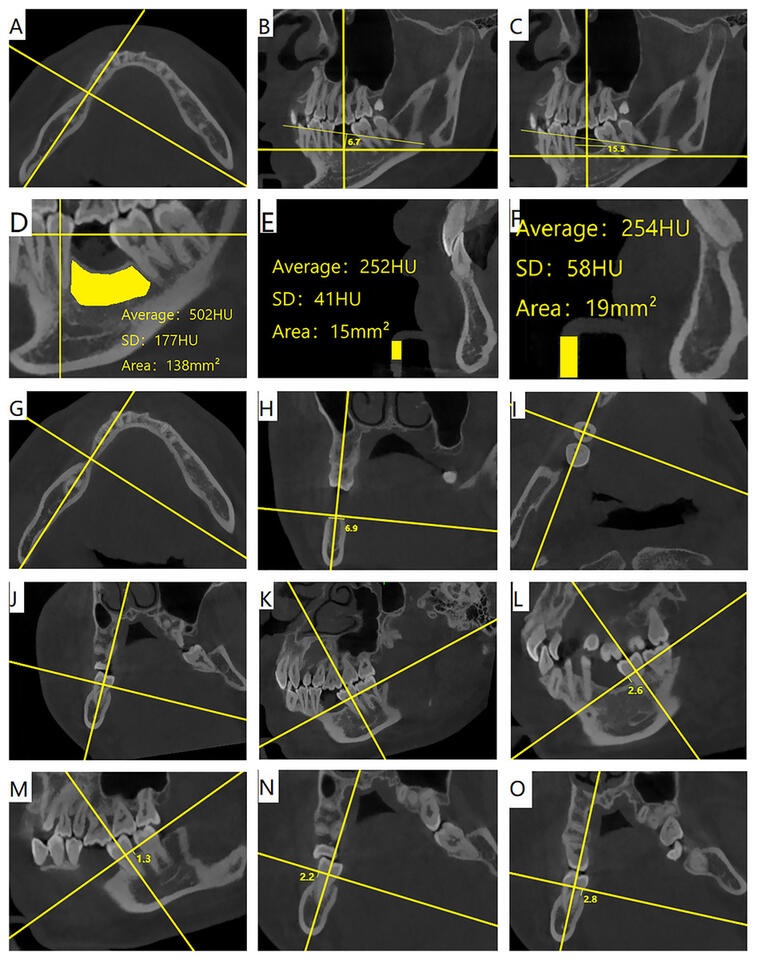 Factors affecting molar root and periodontal hard tissue changes after ...